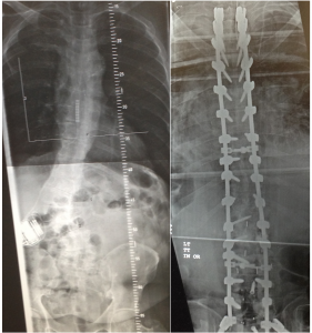 Scoliosis Correction – Pacific Neurophysiologists LLC